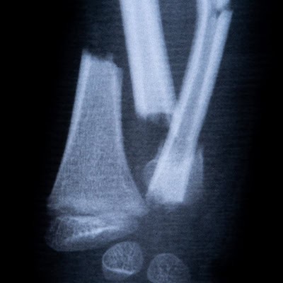 Knochenbrüche behandeln – Fachgerechte Unfallchirurgie